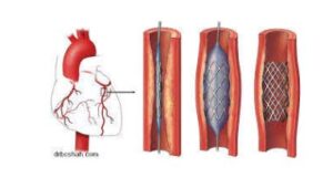 Percutaneous Coronary Intervention, Angioplasty (PCI-Stenting ...
