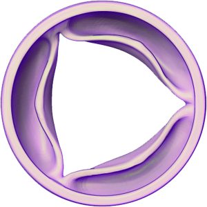 Learn more about Aortic Stenosis - Newcastle Heart